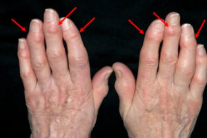 Heberdens Nodes FAQ - OKUNO CLINIC - Pain relief treatment - Japan